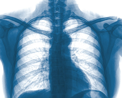Journée Luxembourgeoise contre la BPCO (Broncho pneumopathie chronique ...
